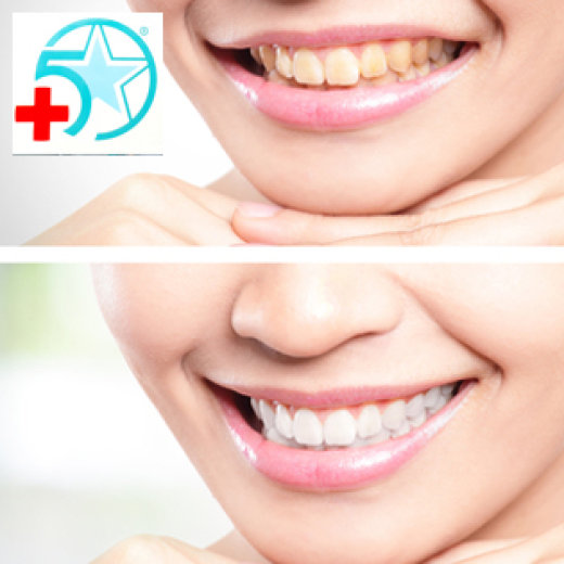 Lấy Cao Răng +Đánh Bóng Răng +Chấm Thuốc Răng Sâu Và Tư Vấn Răng Miệng ...